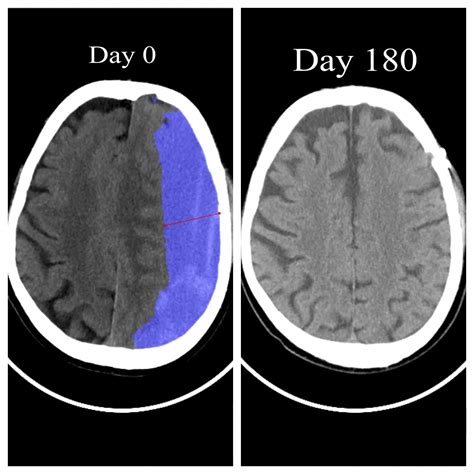 Chronic Subdural Hematoma Vs Acute