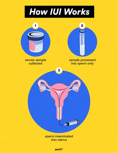 Intrauterine Insemination IUI Uses Procedure Risks And Cost