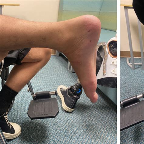 Left Traditional Rotationplasty Where The Patients Ankle Joint Acts Download Scientific