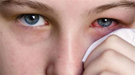 Can You Get Conjunctivitis From Shampoo At Bennie Morris Blog