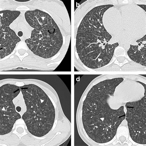 Centrilobular Nodules In High Resolution Computed Tomography Of The Download Scientific Diagram