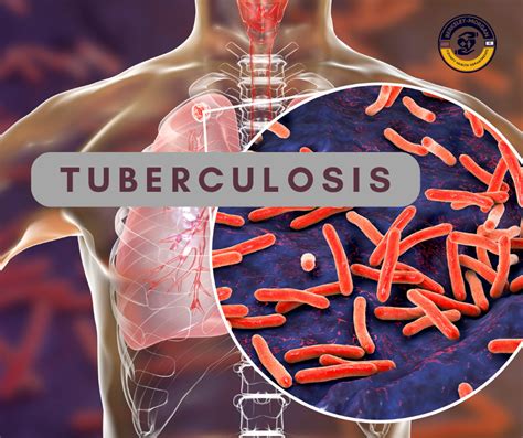 021825 Public Health Education Topic Tuberculosis