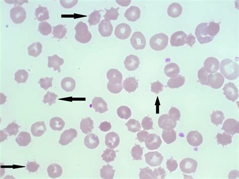 Acanthocytes Spur Cells A Laboratory Guide To Clinical Hematology
