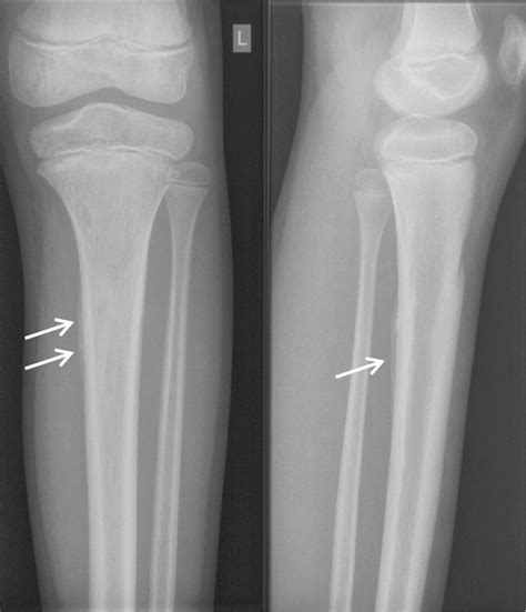 Radiologic Imaging Of Lower Leg Injuries Springerlink