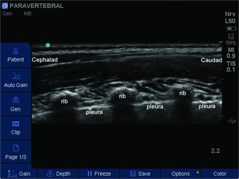 Ultrasound Guided Paravertebral Block Anesthesia Key
