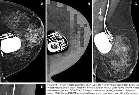 Figure 1 From False Positive And False Negative Contrast Enhanced Mammograms Pitfalls And