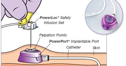 Team Ellie Port Or Hickman Line