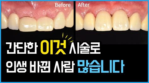 사람 인상 확 좋아지는 이 시술 직접 확인해 보세요 잇몸성형 치은절제술 거미스마일 치과치료 잇몸성형술 잇몸웃음교정 치과추천 치과정보 Youtube