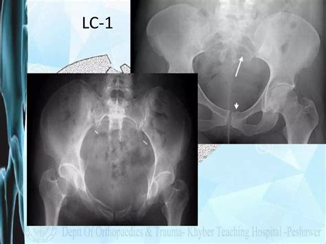 Pelvic Fracture Classification Pptx