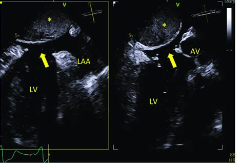 Two Dimensional Tee Midesophageal Orthogonal Imaging 77 And 167