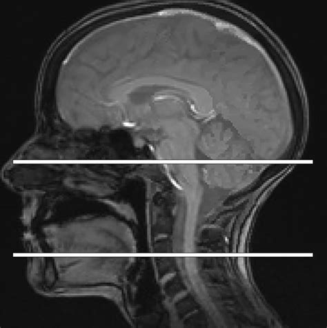 10th Cranial Nerve Mri