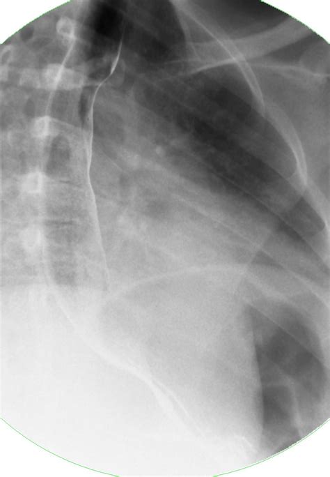 050lu Scleroderma Nsip Acro Osteolysis The Common Vein