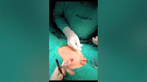 Herniotomy Youtube