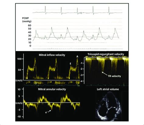 Assessment Patient With Normal Lvef Download Scientific Diagram