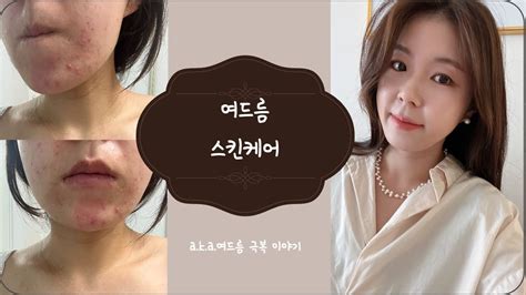 No 광고 내돈내산 여드름 스킨케어 루틴 좁쌀여드름 스킨케어 Youtube