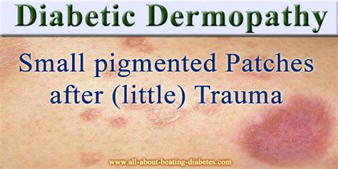 Diabetic Dermopathy A Comprehensive Review
