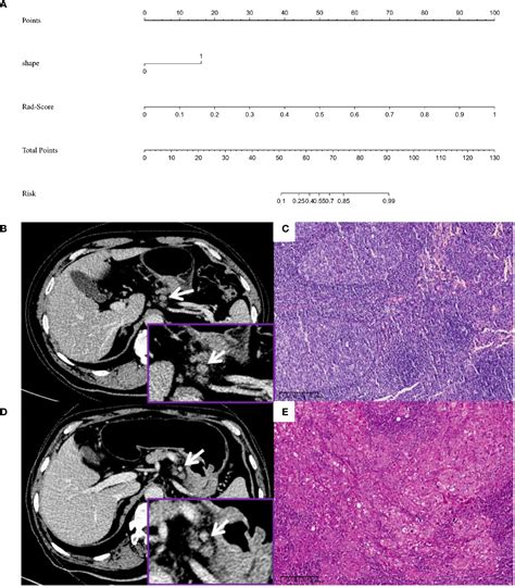 Figure 1 From Prediction Of Lymph Node Metastasis In Advanced Gastric Adenocarcinoma Based On