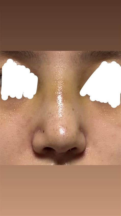 의사에게 물어보세요 코수술 하고 일주일 강남언니 1등 성형수술and피부시술 정보앱