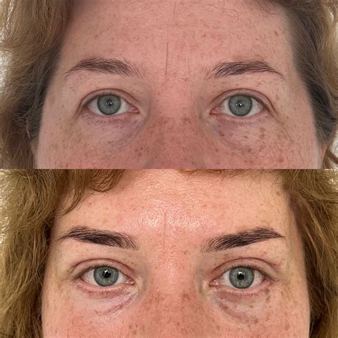 Нижняя блефаропластика пластика нижних век — Бяков Н И