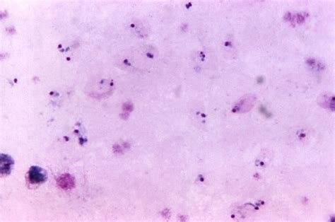 Imagen Gratis Micrografía Plasmodium Falciparum Los Gametocitos