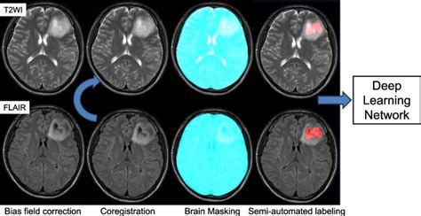 基于放射科医生和人工智能的 T2 Flair 错配征评估和使用合成 Mri 的定量评估在星形细胞瘤、idh 突变和少突胶质细胞瘤、idh 突变