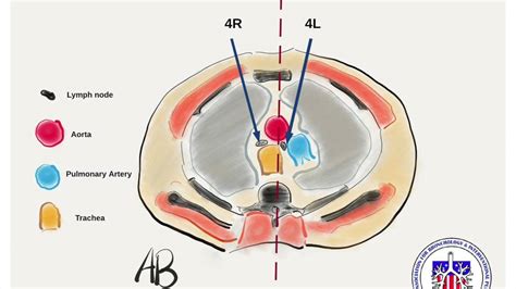 4r Ln Ebus Staging Youtube