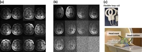 Deep Learning Based Acceleration Of Mri For Radiotherapy Planning Of Pediatric Patients With