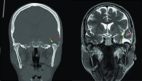 Left Ct Indicates A Left Condylar Dislocation And Absence Of The Download Scientific Diagram