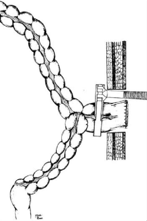 Colostomy Closure By Means Of An Articulating Linear Stapler Download