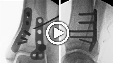 Posteromedial Approach To The Tibia Japanese Subtitles Acumed