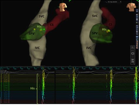 Safety And Feasibility Of Conduction System Pacing In Patients With Congenital Heart Disease
