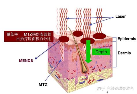 点阵激光的分类和解析 知乎