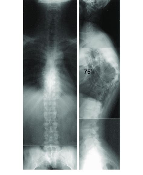 Preoperative Radiographs Of The Patient Aged 38 Years Showing Download Scientific Diagram