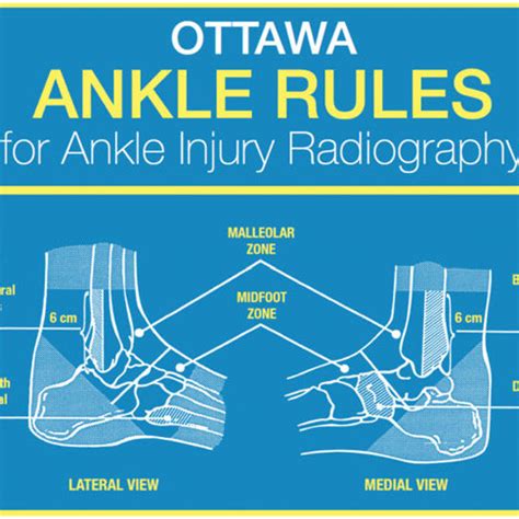 Ottawa Ankle Rules Criteria For X Ray Series Requirements Download