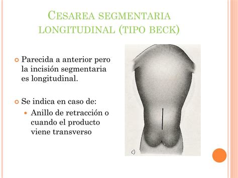 Ppt Cesarea Powerpoint Presentation Free Download Id4187366