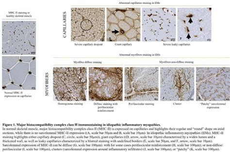 Pos0490 Usefulness Of Mhc Ii Immuno Staining On Muscle Biopsies In