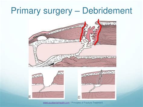 Ppt Open Fractures Principles Of Management Powerpoint Presentation Free Download Id6108962