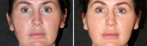 Quanta Light Evo And Suprema Laser Treatments In Alpharetta And Atlanta