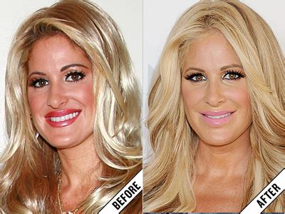 Kim Zolciak Before And After Nose Job