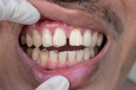 In His Front Teeth Gap