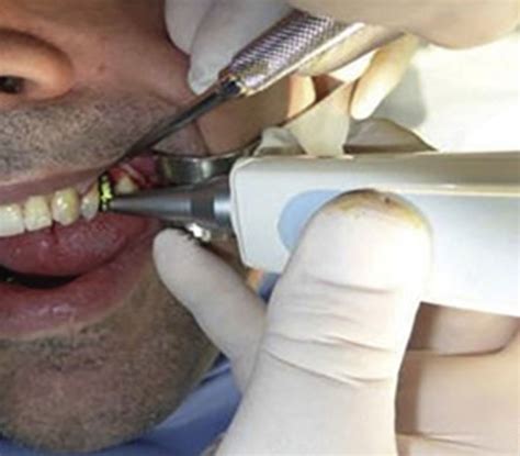 Periotest Stability Measuring System Dandal Model V With Cord