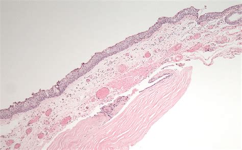 Ocular Cicatricial Pemphigoid Atypical Presentation