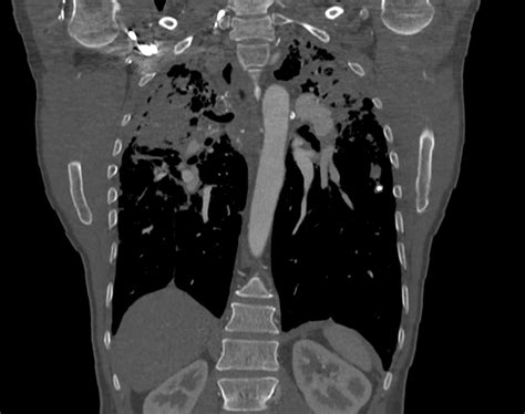 Progressive Massive Fibrosis In A Patient With Silicosis Eurorad