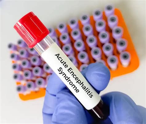 Acute Encephalitis Syndrome Aes A Complete Guide