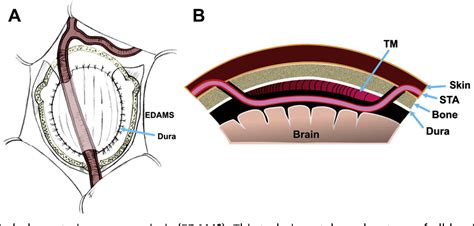 Figure 7 From Indirect Revascularization Techniques For Treating