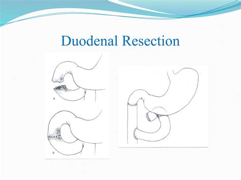 Diagnostico Y Manejo Del Trauma Duodenalpptx