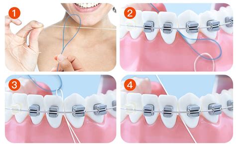 Vinsulla Floss Threaders For Braces Bridges And Implants