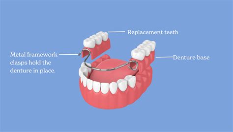Removable Partial Denture Steps Partial Dentures Cost Types And