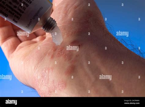 Psoriasis Treatment Male Patient Using Dovonex Ointment On Area Of