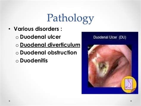 Duodenum And Duodenal Diverticulum